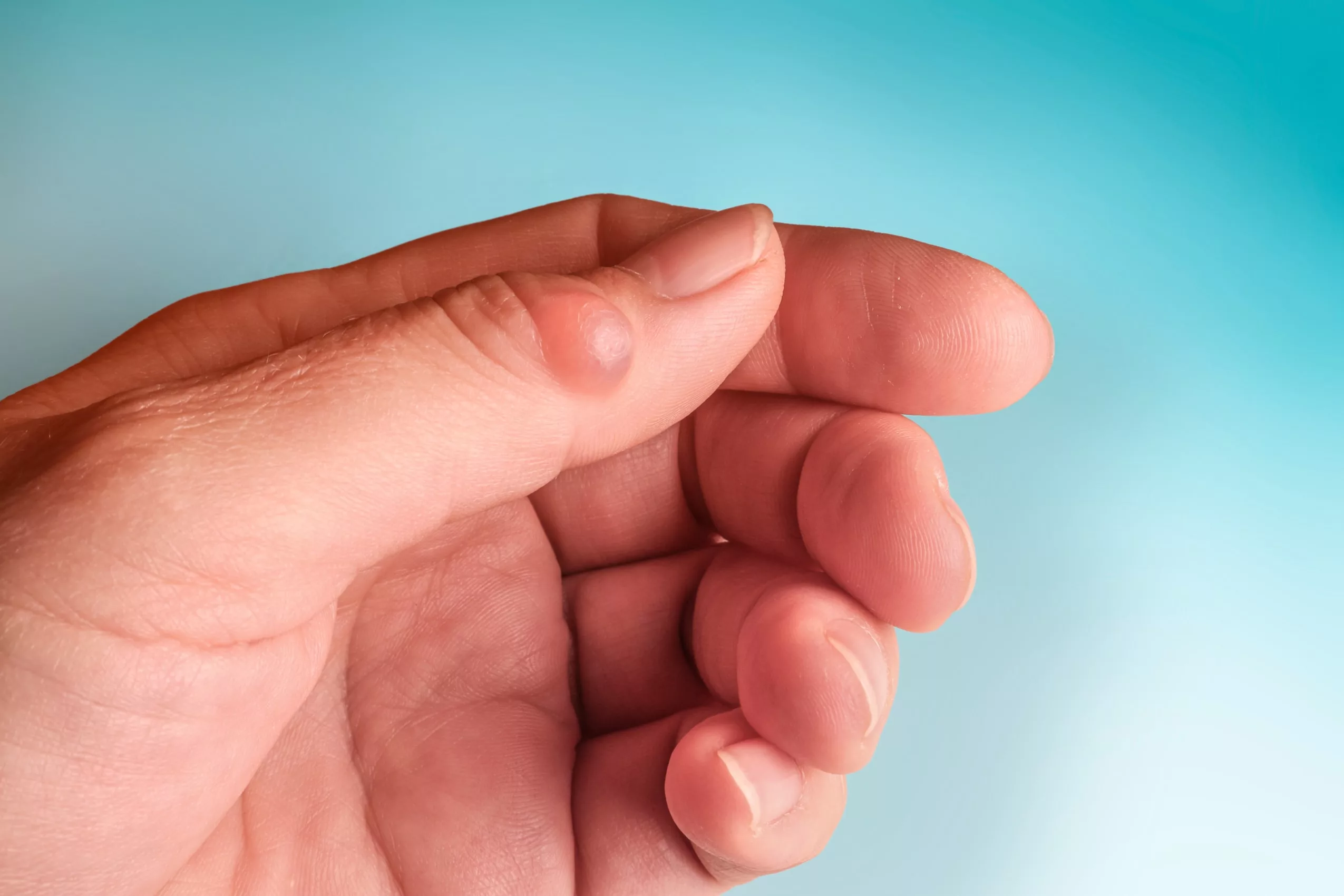 Kyste Mucoïde des Doigts à Bordeaux | Clinique de la Main